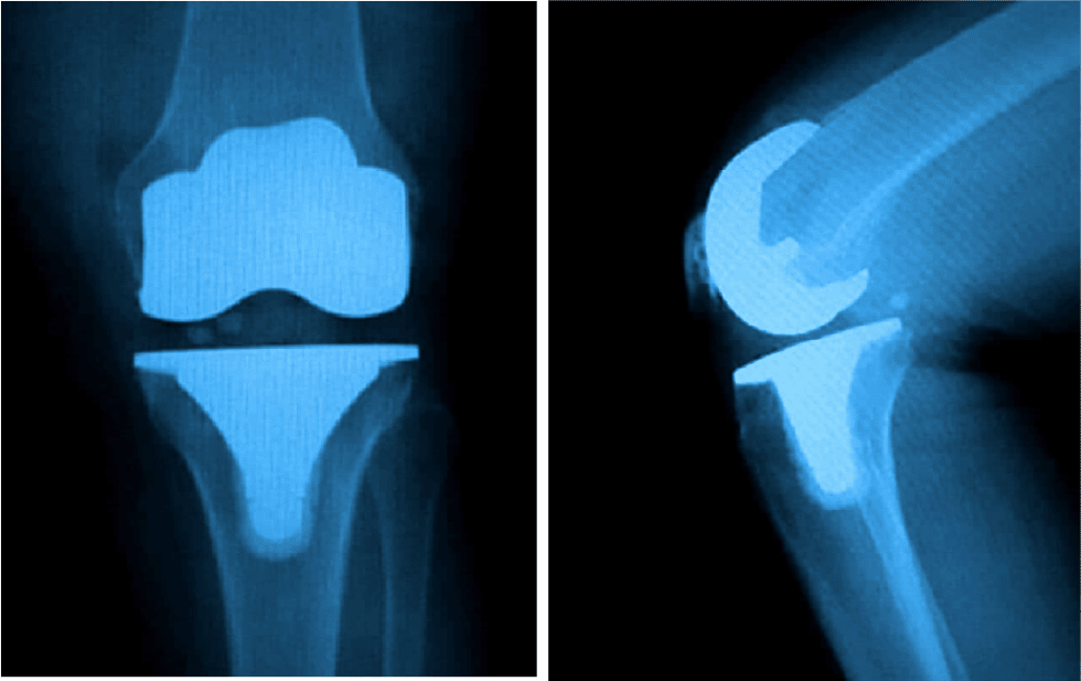Prótesis de rodilla | B & B Medic Group