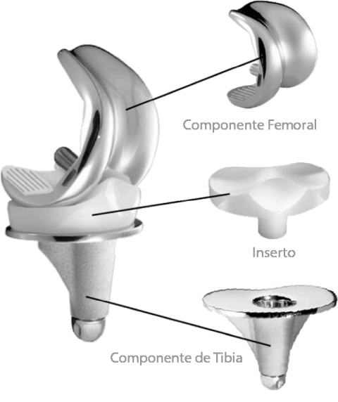 Prótesis de rodilla | B & B Medic Group