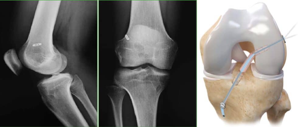 Lesión de ligamento cruzado anterior | B & B Medic Group