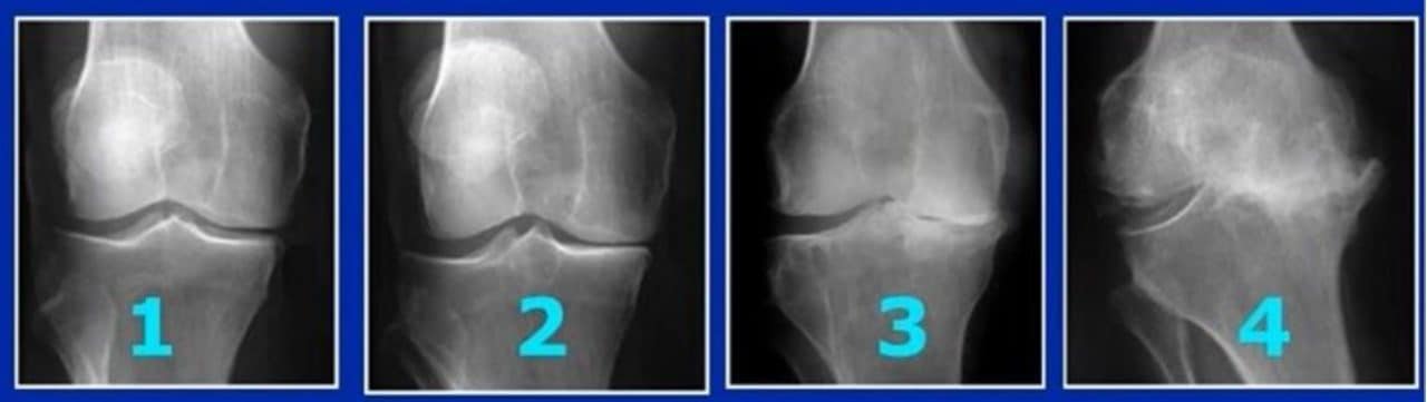 Osteoartrosis | B & B Medic Group